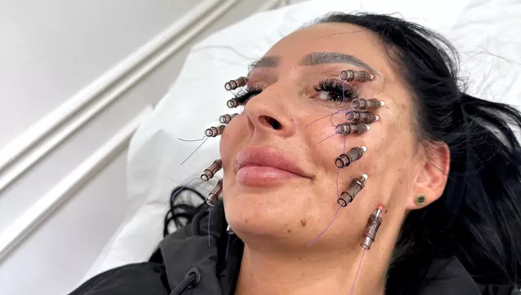 Transformare fără bisturiu: liftingul facial cu fire resorbabile | Unica.ro